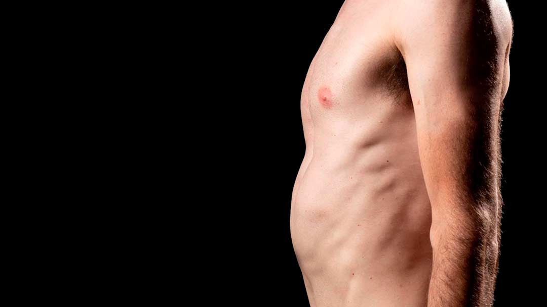 PECTUS EXCAVATUM E CARINATUM - Icator
