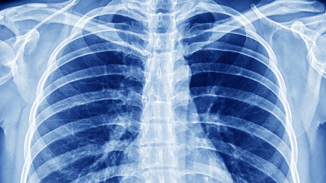 Trauma Torácico: Lesões, Tratamento e Cirurgia - Icator